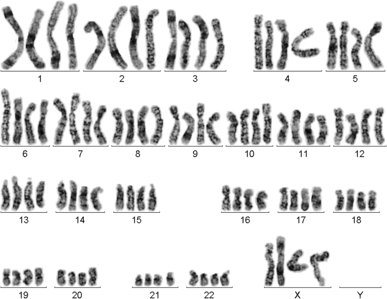 A new adult AML case with an extremely complex karyotype, remission and ...