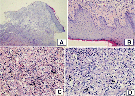 Progressive cutaneous Cryptococcosis complicated with meningitis in a ...