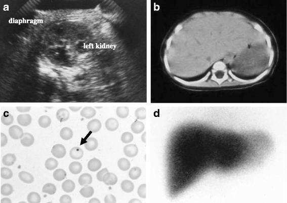 Sporadic isolated congenital asplenia with fulminant pneumococcal ...