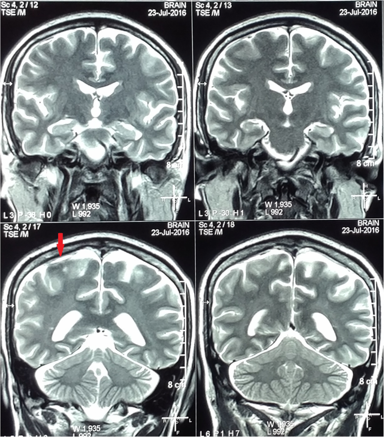 Melioidosis with a subdural collection – a case report | BMC Infectious ...
