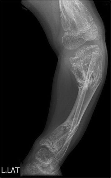 Radiographic features of Ollier’s disease – two case reports | BMC ...