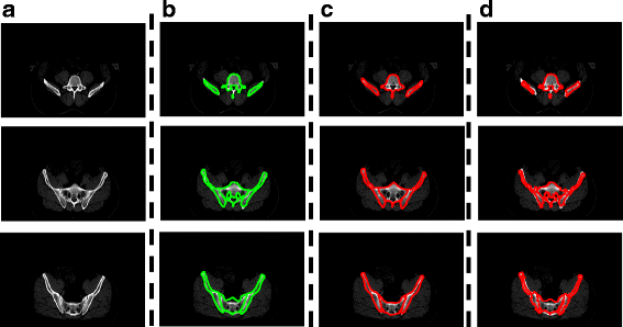 The Segmentation Of Bones In Pelvic Ct Images Based On Extraction Of