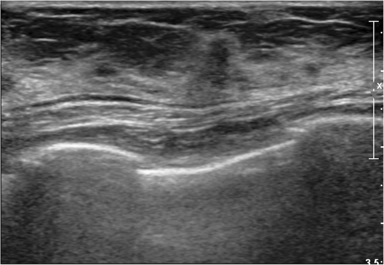 Radial scars/complex sclerosing lesions of the breast: radiologic and ...