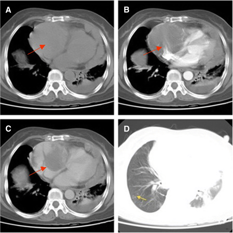 Clinical and imaging manifestations of primary cardiac angiosarcoma ...