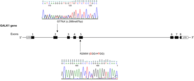 Clinical profile and molecular characterization of Galactosemia in ...