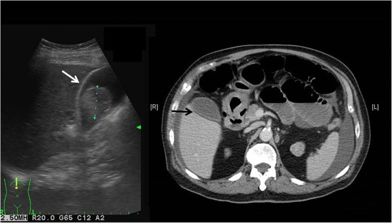 Green dialysate and gallbladder perforation in a peritoneal dialysis patients: a case report and ...