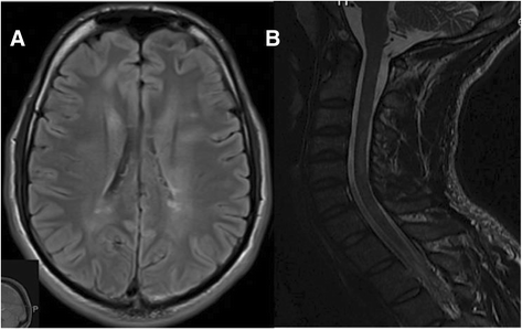 Spinal segmental myoclonus as an unusual presentation of multiple ...