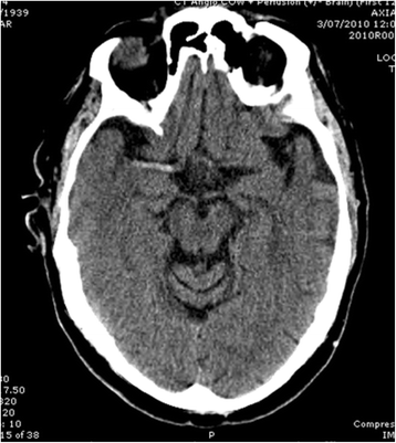 Is there association between hyperdense middle cerebral artery sign on ...