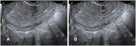 Uterine Rupture After C Section