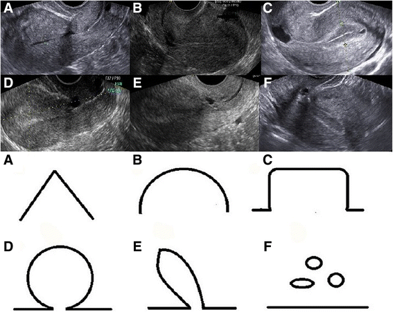 Risk factors for Korean women to develop an isthmocele after a cesarean ...