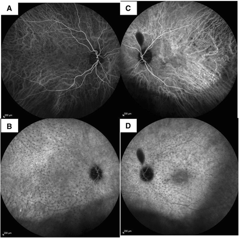 Bilateral Diffuse Uveal Melanocytic Proliferation (BDUMP) associated ...