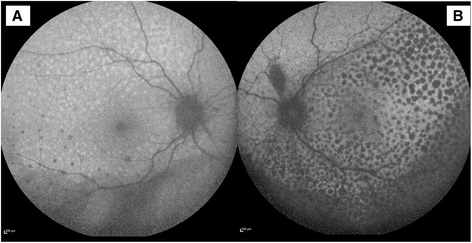 Bilateral Diffuse Uveal Melanocytic Proliferation (BDUMP) associated ...