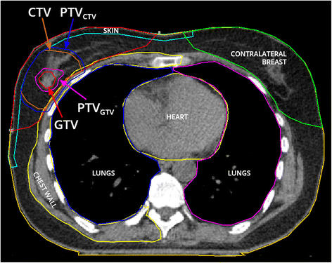 Redefining radiotherapy for early-stage breast cancer with single dose ...