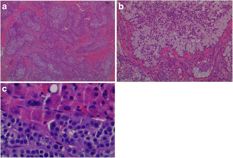Malignant acrospiroma: a case report in the era of next generation ...