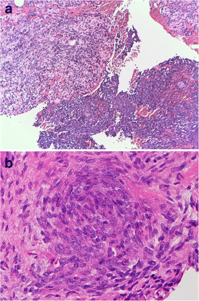 Intraosseous synovial sarcoma of the distal ulna: a case report and ...