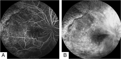 Primary extranodal marginal zone B-cell lymphoma with diffuse uveal ...
