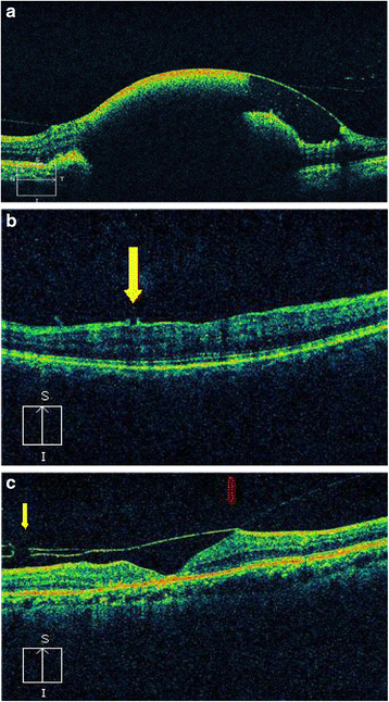Nd:YAG laser hyaloidotomy in the management of Premacular Subhyaloid ...