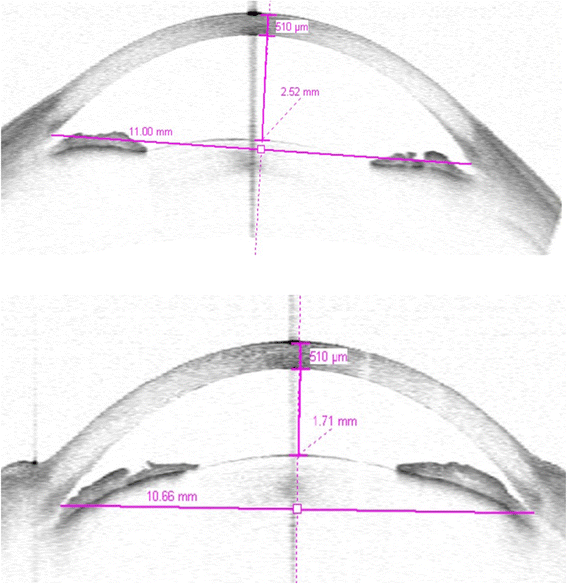 Changes in axial length, central cornea thickness, and anterior chamber ...