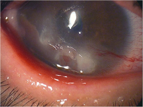 Morphological changes in the meibomian glands of patients with phlyctenular keratitis: a ...