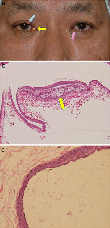 Steatocystoma simplex of the lacrimal caruncle: a case report | BMC ...