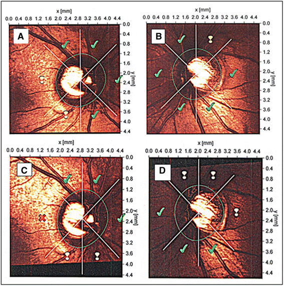 Choroidal infarction in a glaucoma patient with Flammer syndrome: a ...