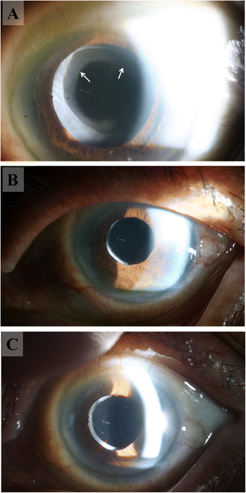 Reversible opacification of hydrophobic acrylic intraocular lens- two ...