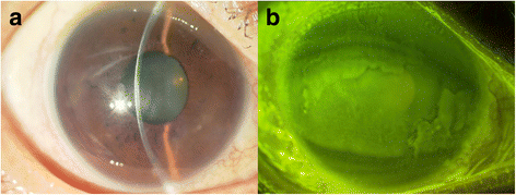 Hemorrhagic hypopyon as presenting feature of intravascular lymphoma, a ...