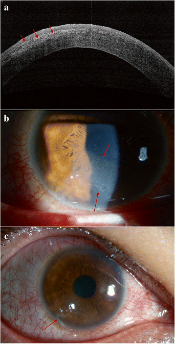 Late-onset diffuse lamellar keratitis 4 years after femtosecond laser ...