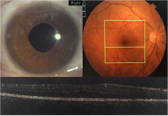 Monocular lens dislocation due to vomiting-a case report | BMC ...