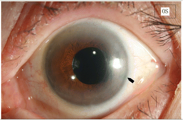 Surgical peripheral iridectomy via a clear-cornea phacoemulsification ...