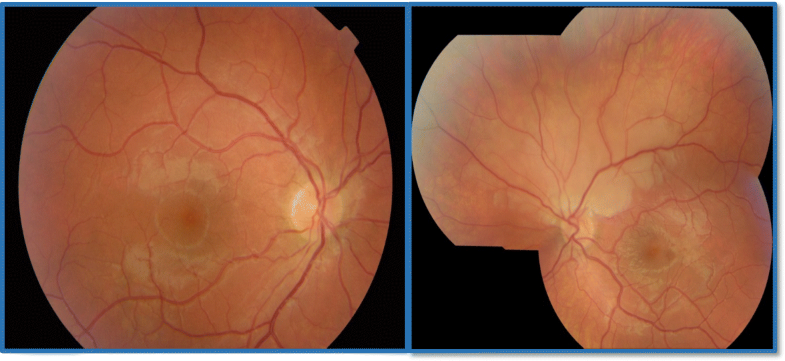 A case report of branch retinal artery occlusion in a teenager due to ...
