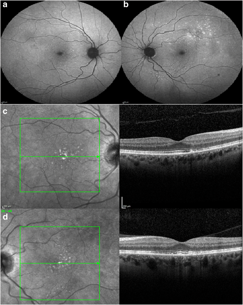 An unusual case report of primary vitreoretinal lymphoma | BMC ...