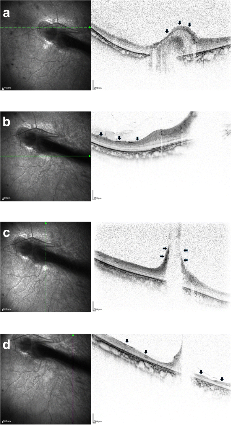 Optical coherence tomography findings of falciform retinal detachment ...