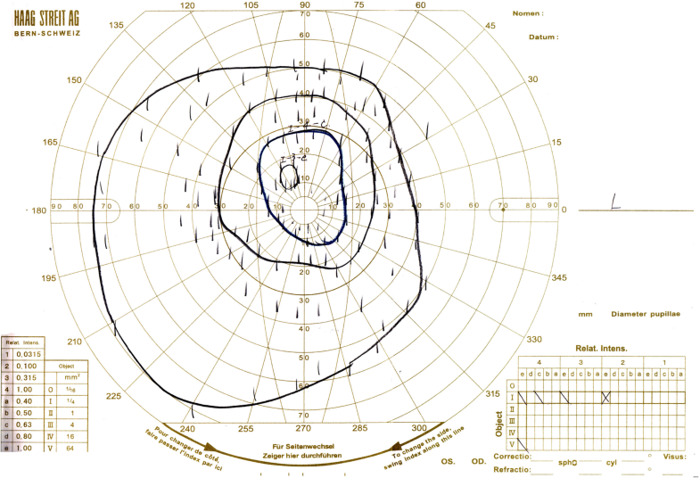 Optical coherence tomography findings of falciform retinal detachment ...