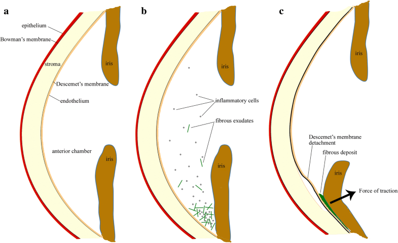 Tractional Descemet’s membrane detachment after ocular alkali burns ...