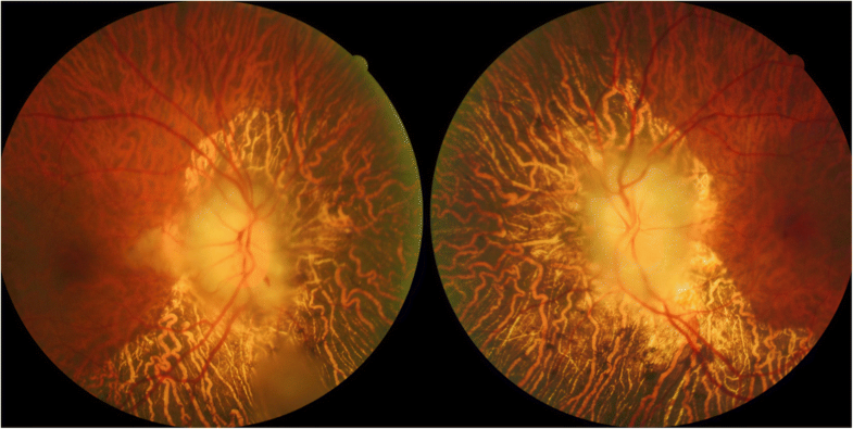 Giant cell arteritis presenting as bilateral anterior ischemic optic ...