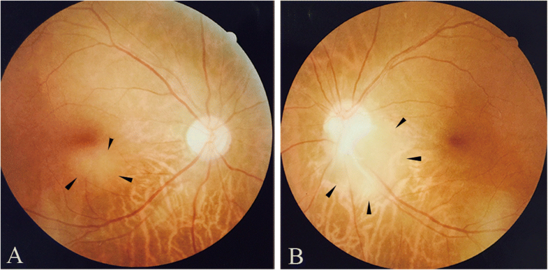 Retinal astrocytic hamartoma in tuberous sclerosis complex in an ...