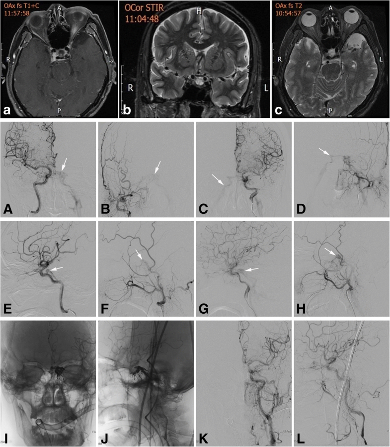Carotid-cavernous fistula(CCF) presenting as paroxysmal painful ...