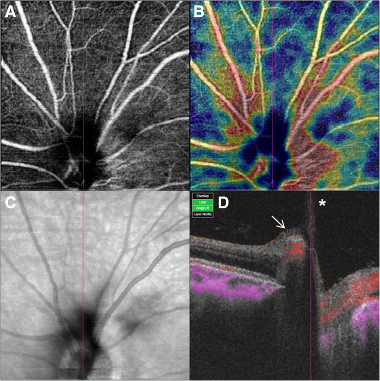 OCT angiography of persistent hyaloid artery: a case report | SpringerLink