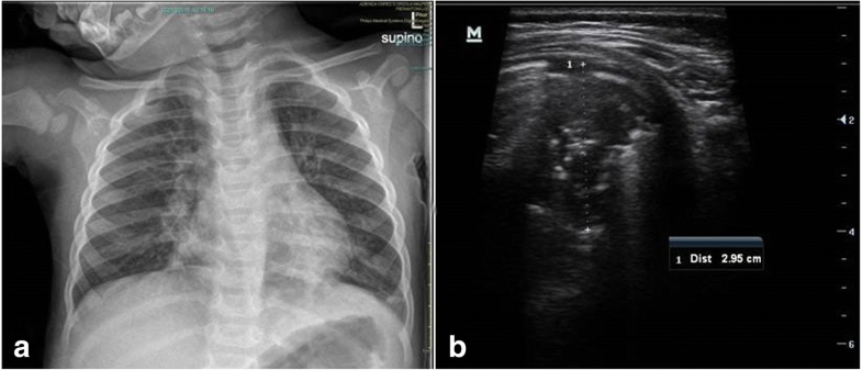 Lung ultrasound for the diagnosis of pneumonia in children with acute ...