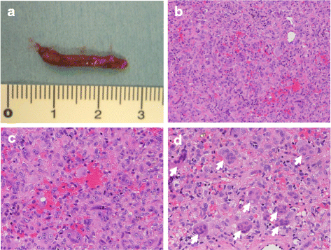 Giant cell tumor of the clavicle: report of a case in a rare location ...