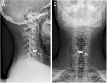Cervical arthroplasty with ROTAIO® cervical disc prosthesis: first ...