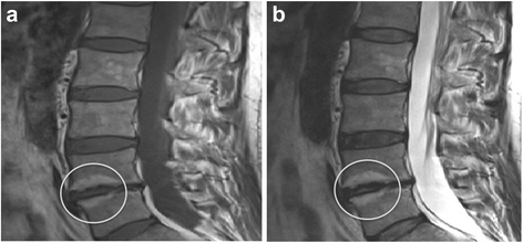 Modic changes in the lumbar spine and their association with body ...