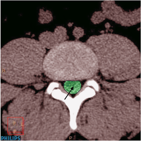 Paraspinal muscles density: a marker for degenerative lumbar spinal ...