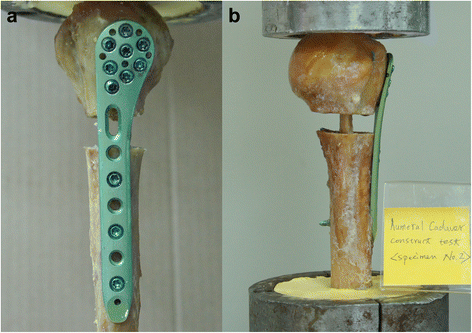 Intramedullary cortical bone strut improves the cyclic stability of ...