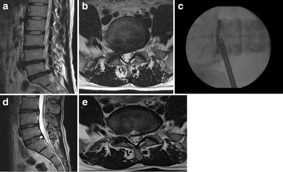 Percutaneous endoscopic lumbar discectomy: minimally invasive technique ...