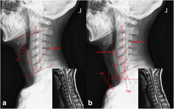 Characteristics of cervical sagittal parameters in healthy cervical ...