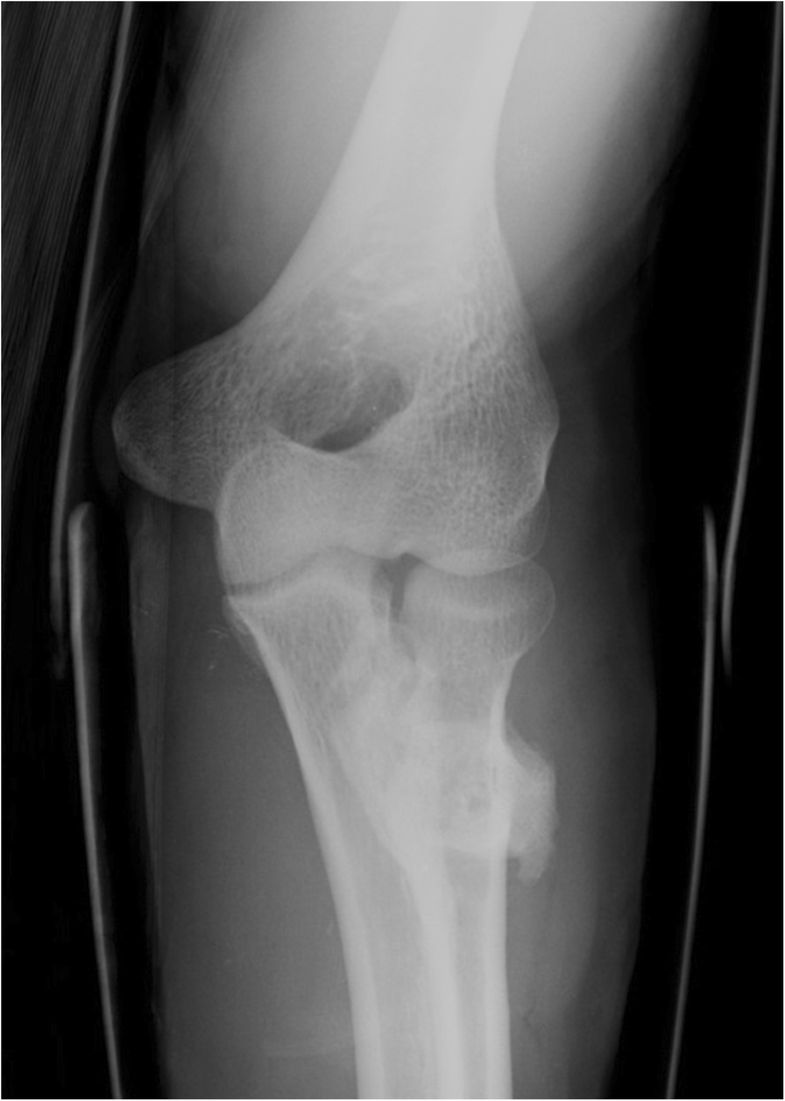 Distal biceps tendon rupture: advantages and drawbacks of the ...