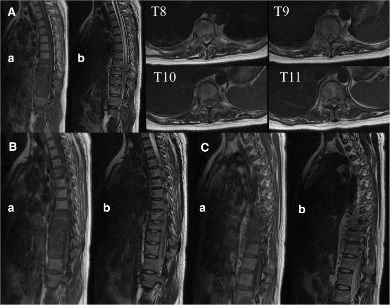 SAPHO syndrome with pathological fractures of vertebral bodies: a case ...