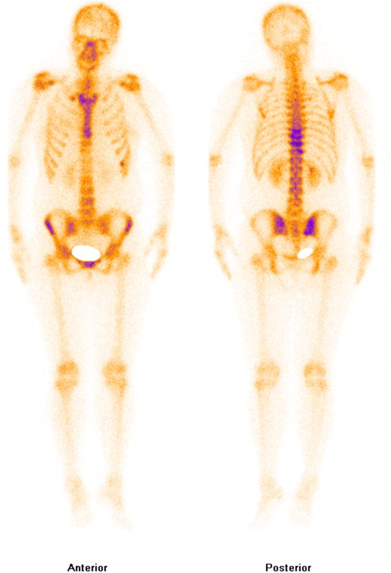 SAPHO syndrome with pathological fractures of vertebral bodies: a case ...